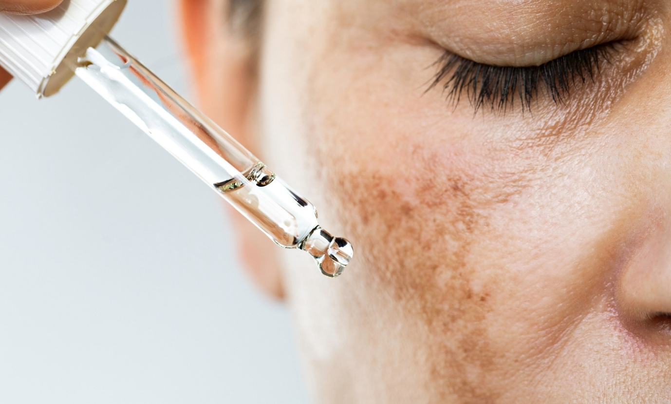 Manchas de sol! Como tratar o melasma - Maior Viagem